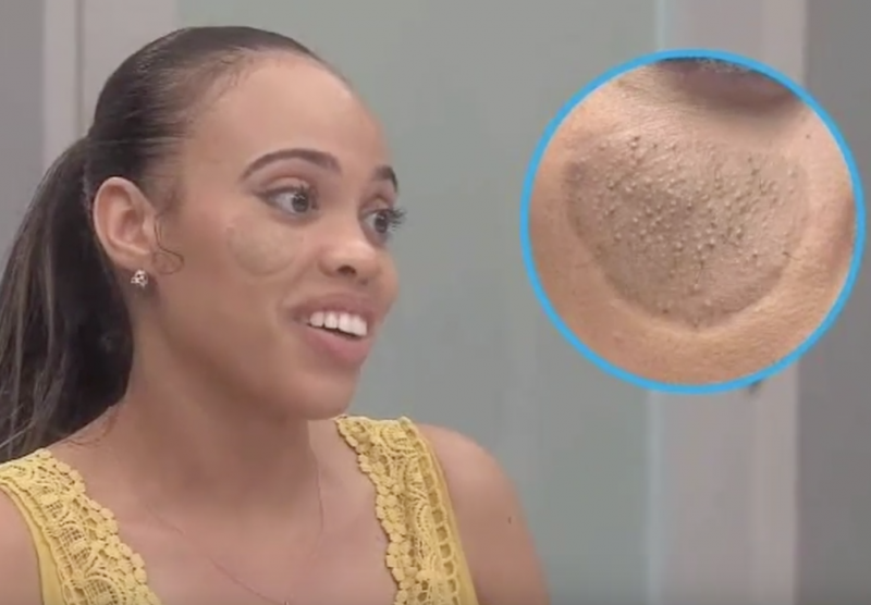 Cirurgia plástica faz mulher sofrer com pelos pubianos no rosto