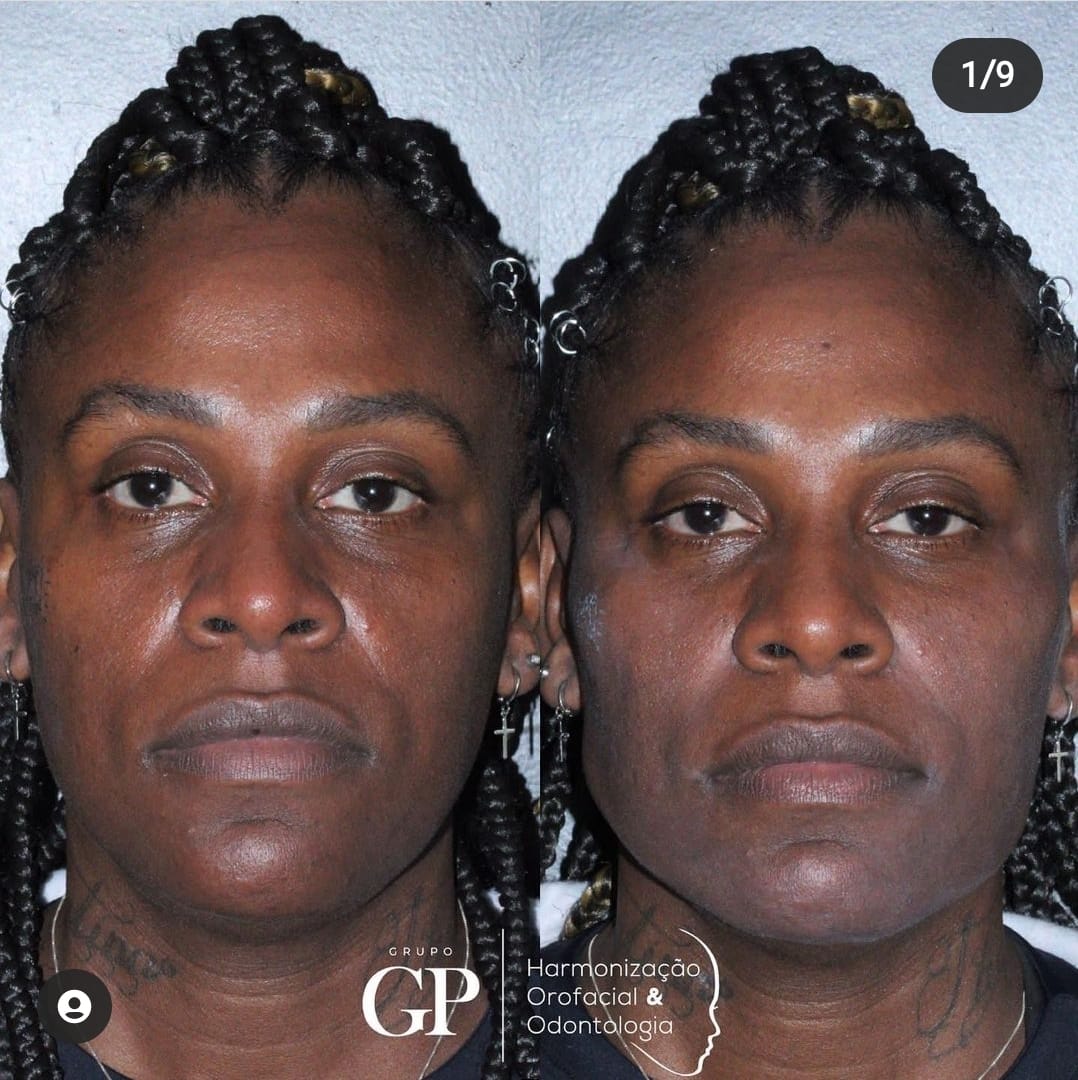 Fotos De Pegym Antes Depois David Pegram