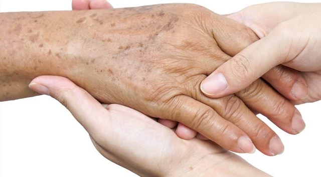 Dicas de como tratar manchas causadas pelo excesso de sol