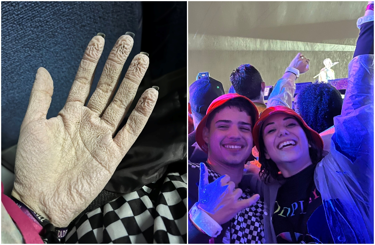 Fã mostra mão enrugada após show de Coldplay no Rock in Rio e viraliza