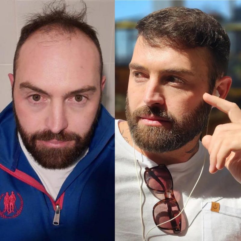 Esta é a melhor notícia sobre a cura da calvície