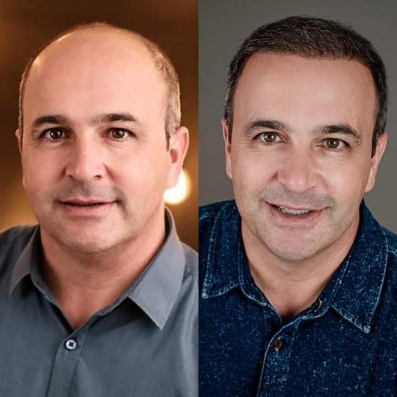 Esta é a melhor notícia sobre a cura da calvície