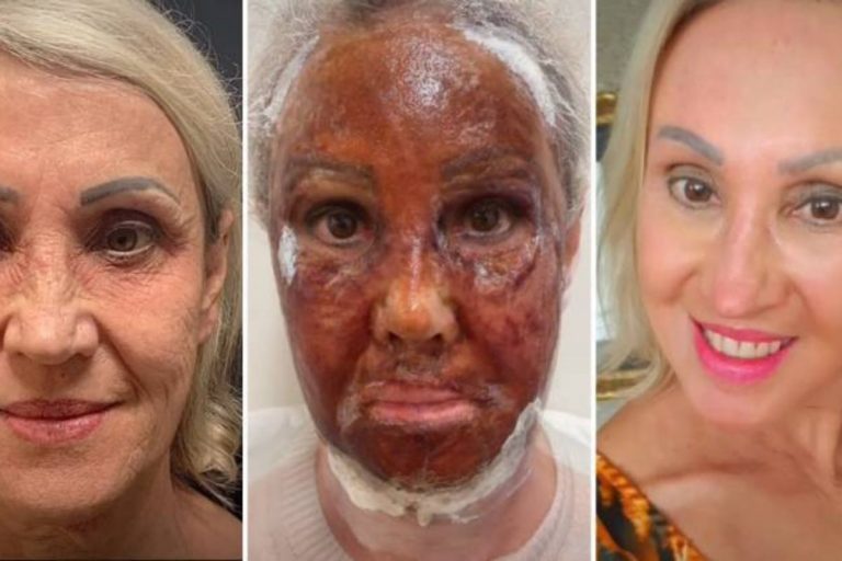 Morte por peeling de fenol: descubra os riscos e tipos