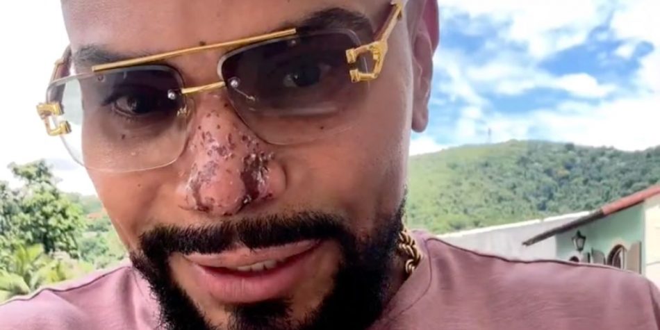 Nariz podre: Naldo não é o único famoso a sofrer com procedimento ...