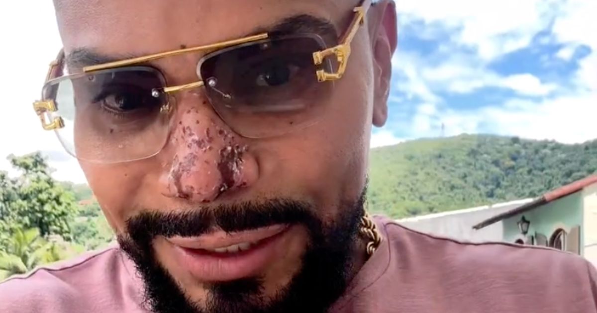 Nariz podre: Naldo não é o único famoso a sofrer com procedimento ...