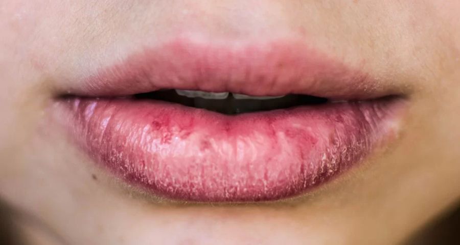 Câncer de lábio: dermatologista explica doença e dá dicas de prevenção