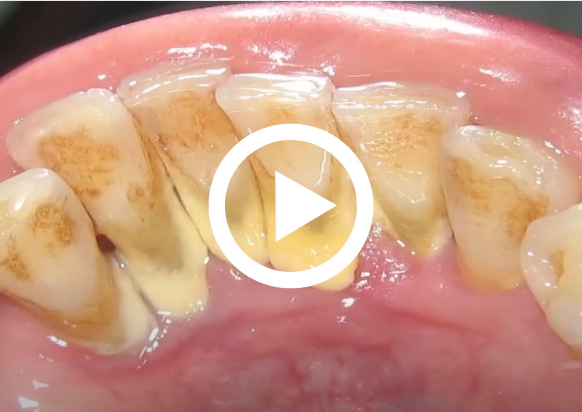 Adeus tártaro e bafão com receita caseira de 3 ingredientes