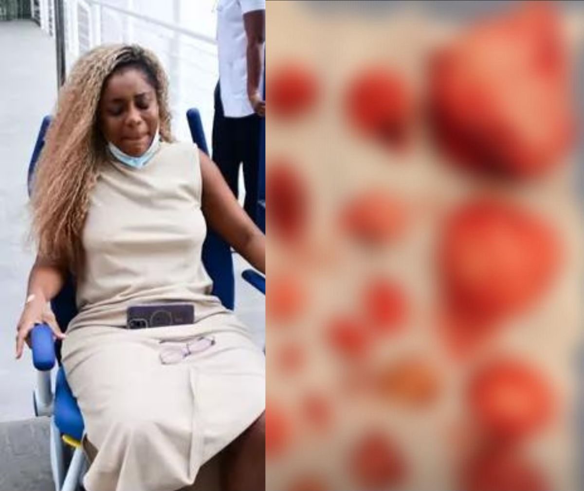 Cariúcha mostra os 17 miomas que foram retirados do seu útero ...