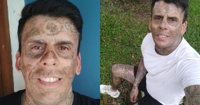 Homem mais tatuado do Brasil inicia processo de remoção