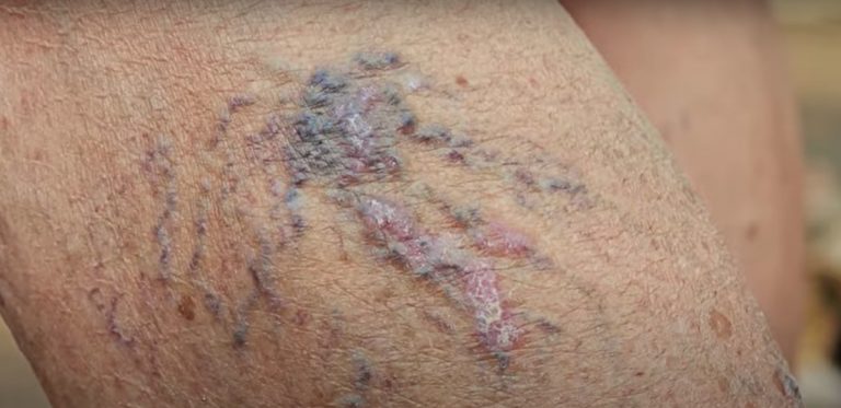 Varizes e dores nas pernas? Chá potente melhora a circulação