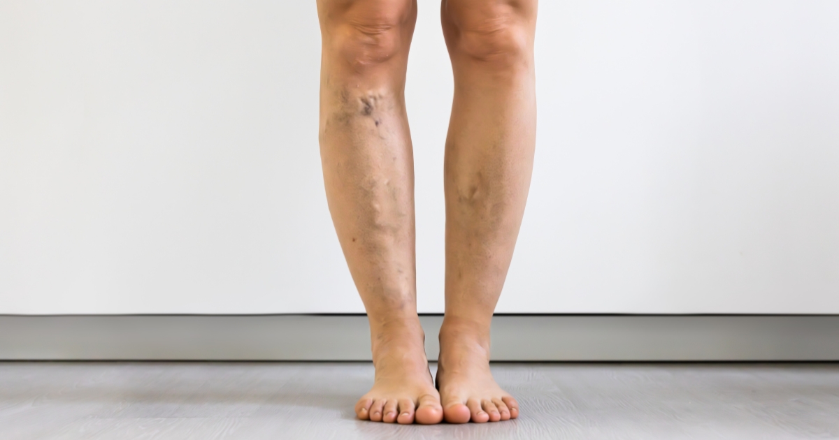 Varizes: 10 dicas para eliminar as dores nos dias quentes