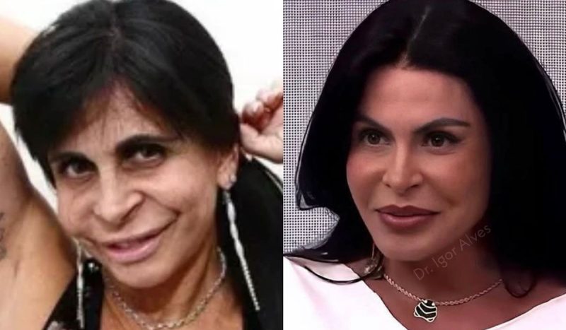 Outra pessoa? Gretchen aparece com 'novo rosto'; veja foto